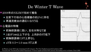 心筋梗塞の心電図：De Winter T Wave | こっそりEBM勉強会