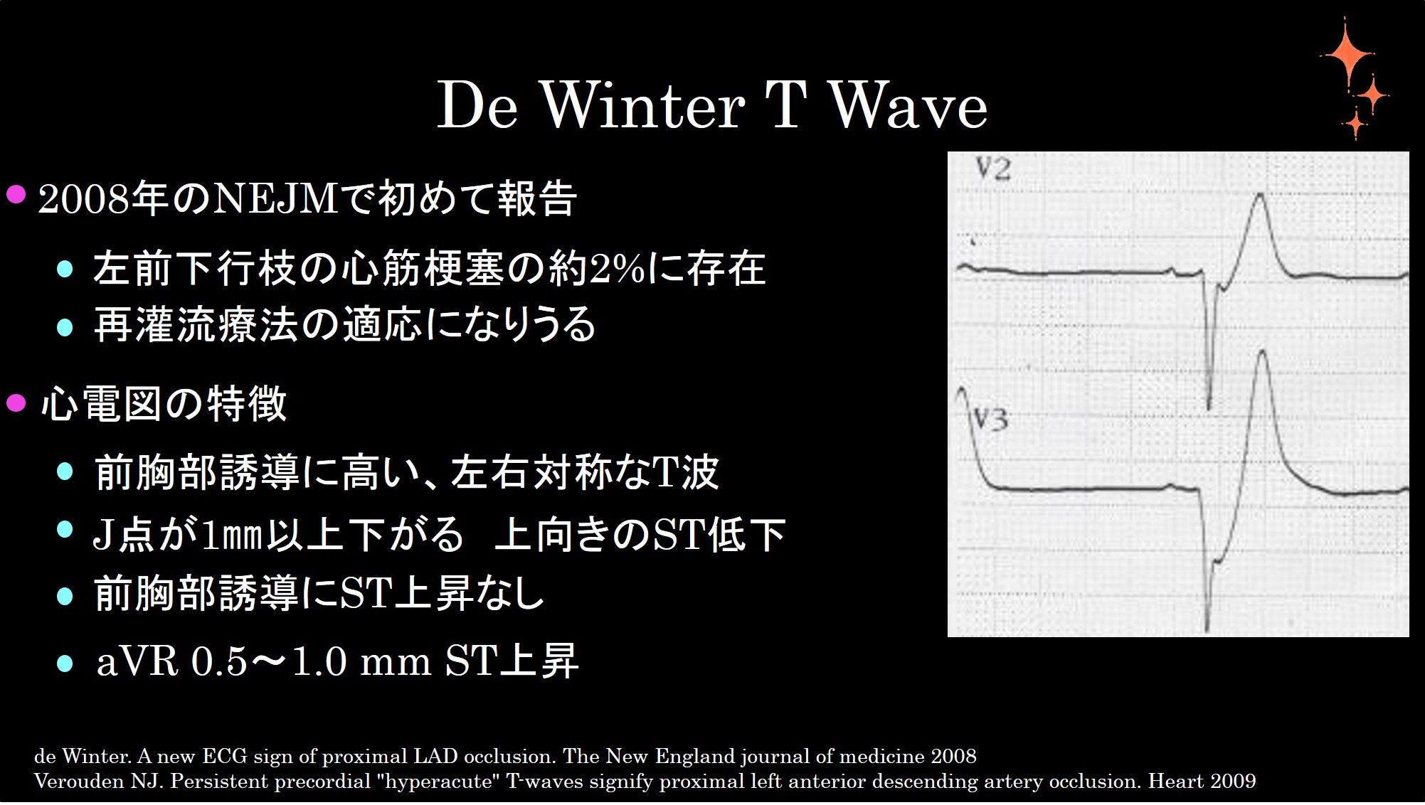 心筋梗塞の心電図：De Winter T Wave | こっそりEBM勉強会