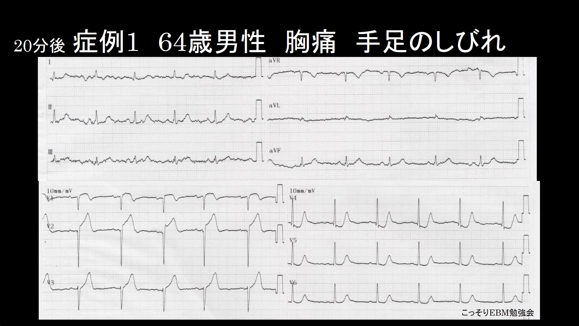 心筋梗塞の心電図：De Winter T Wave | こっそりEBM勉強会
