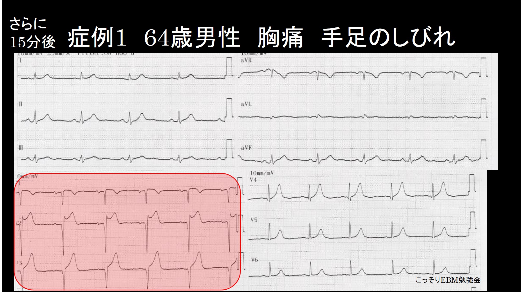心筋梗塞の心電図：De Winter T Wave | こっそりEBM勉強会