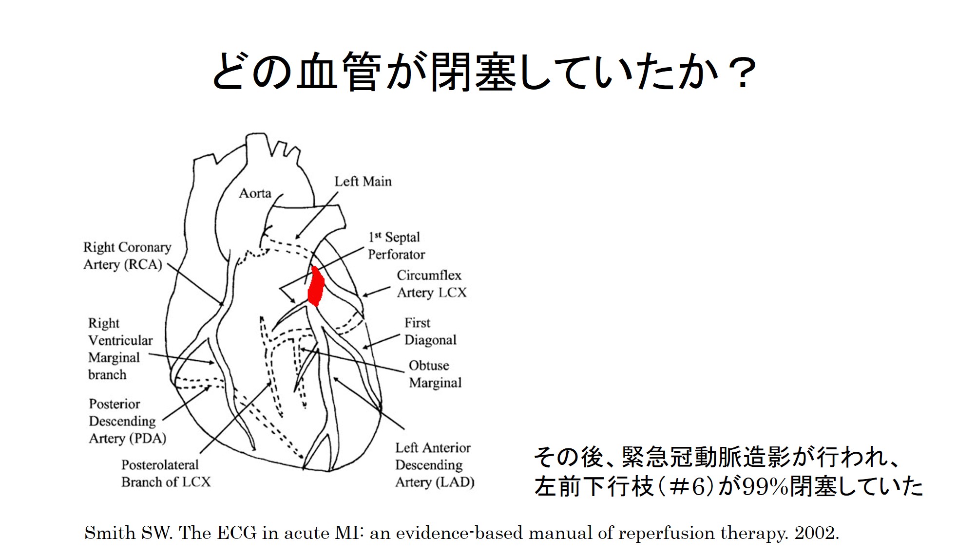 心筋梗塞の心電図：De Winter T Wave | こっそりEBM勉強会