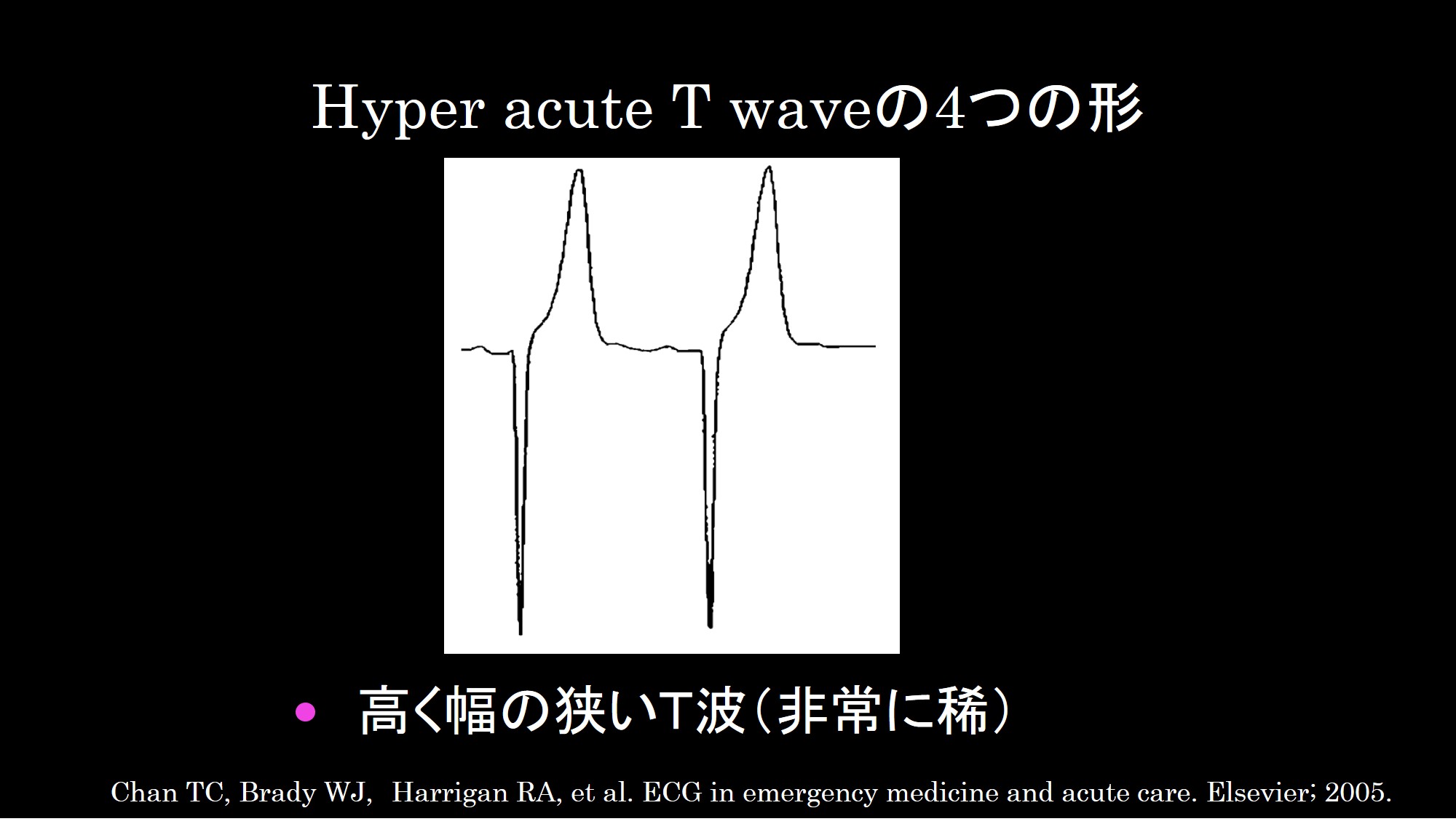 心筋梗塞の心電図：Hyper acute T waveについて | こっそりEBM勉強会