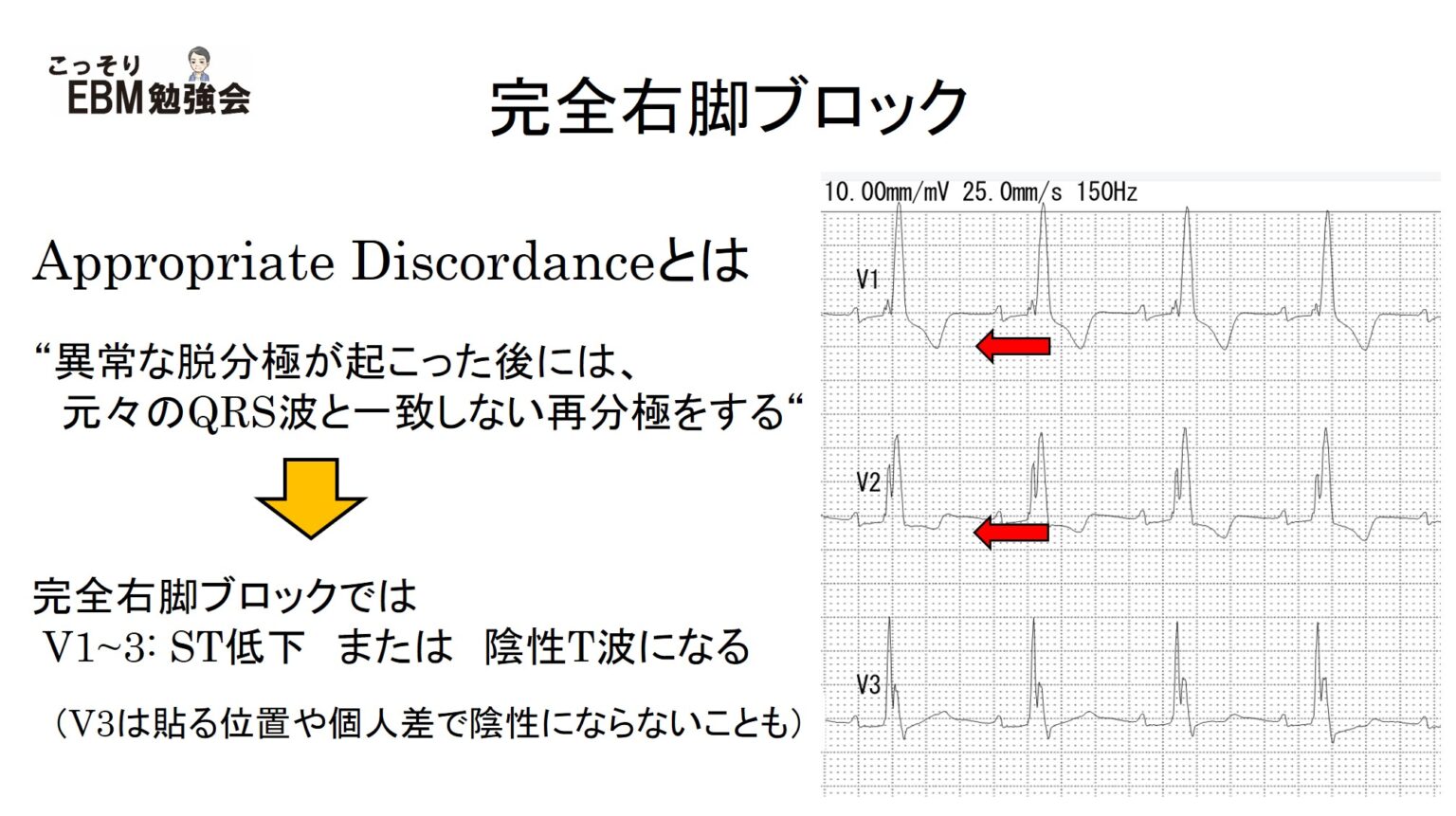 分かる！右脚ブロックの心電図 | こっそりEBM勉強会