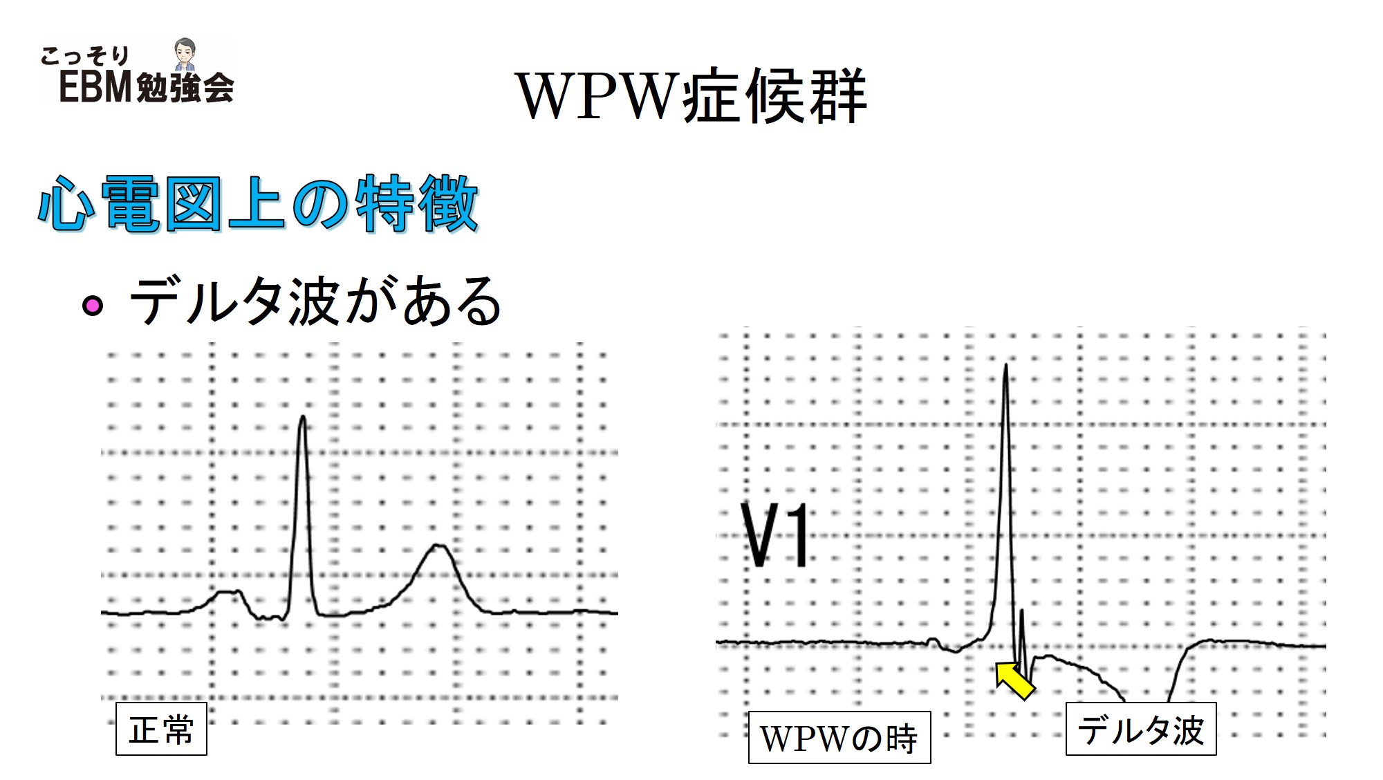 wpw症候群 b型とは _ wpw症候群とは 心電図 – ZYKZ
