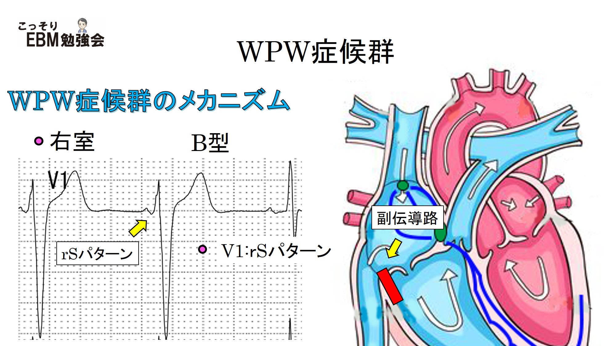wpw症候群 b型心電図 – wpw症候群b型とは – UNII