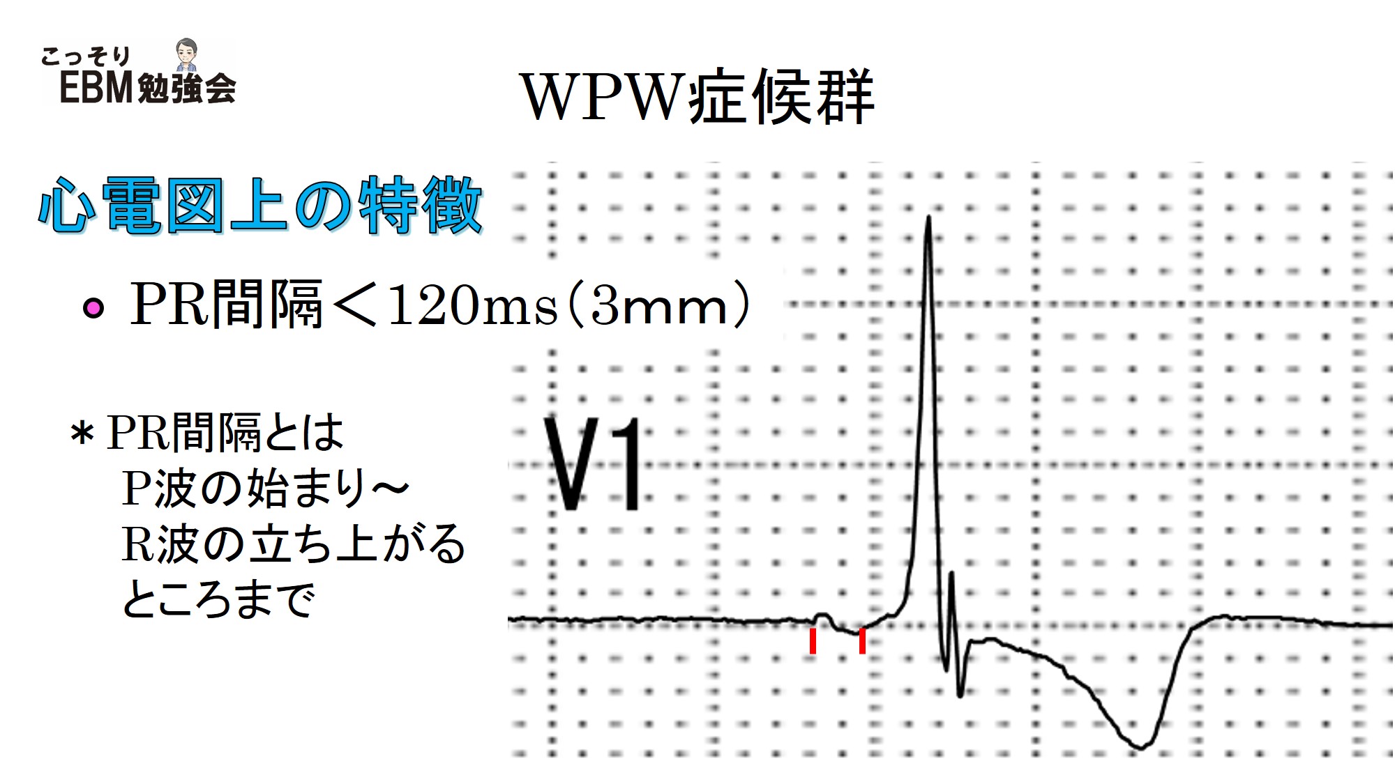 wpw 型 – wpw型心電図とは – NMVCP